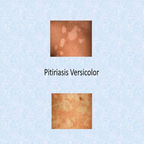 Pitiriasis versicolor | PPTX