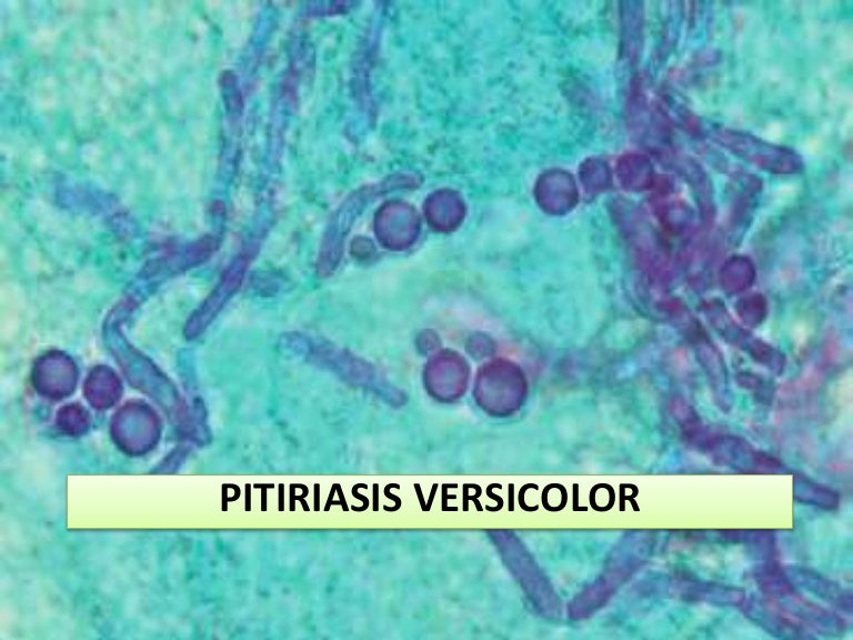 Pitiriasis Versicolor