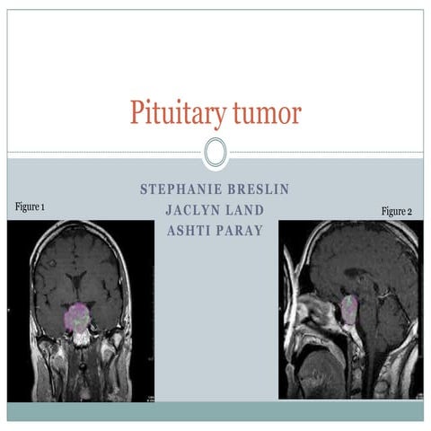 Pituitary tumor powerpoint table 3 | PPTX | Thyroid Disorders ...