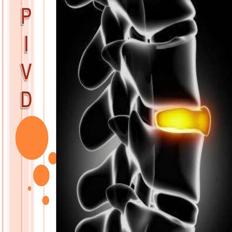 PIVD Prolapsed Intervertebral Disc | PPT