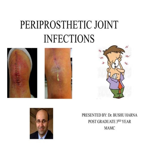 Periprosthetic Joint Infection | PPTX
