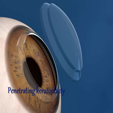 management of corneal scar, penetrating keratoplasty | PPT