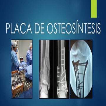 PLACAS DE OSTEOSÍNTESIS Y PROCEDIMIENTOS QUIRURGICOS.pptx