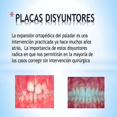 Arco facial extra oral | PPTX