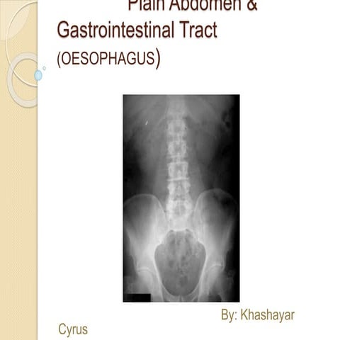 Comprehensive Overview of Pneumoperitoneum: Causes, Diagnosis, and ...