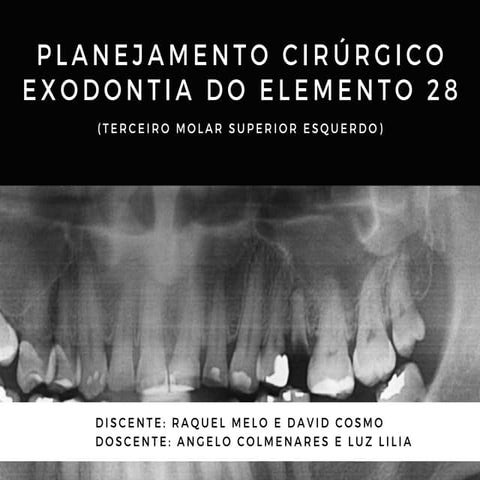 PLANEJAMENTO CIRÚRGICO EXODONTIA DE RESTO RADICULAR DO ELEMENTO 25 ...