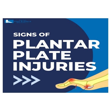 Sign of Plantar Plate Injuries - Certified Foot | PDF