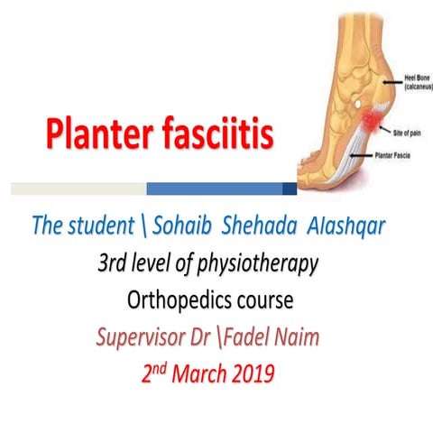 Planter fasciitis | PPTX
