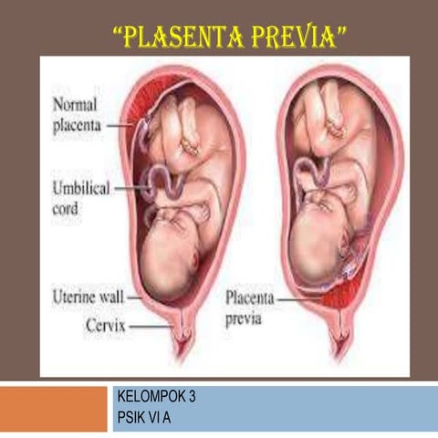 Plasenta previa | PPTX