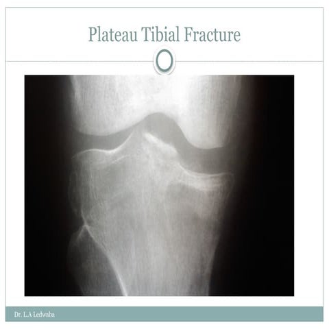 Plateau Tibial Fracture presentation (1).pptx