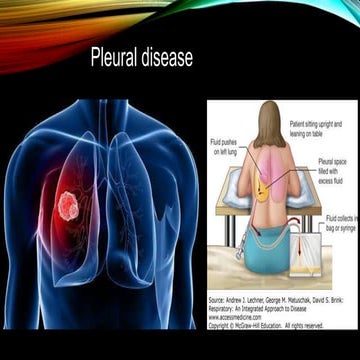 Pleural disease | PPTX