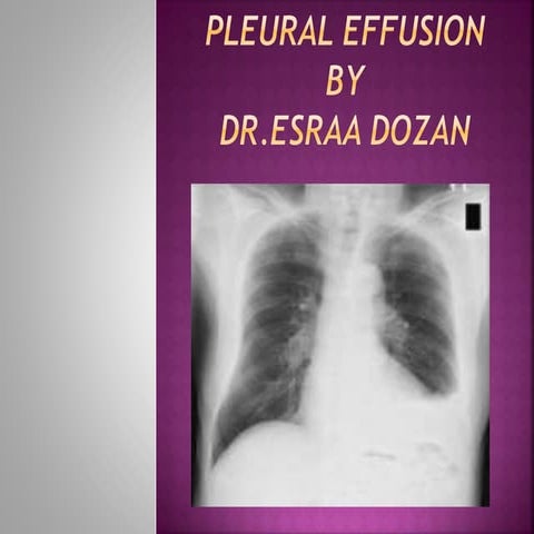 Pleural effusion(X-ray Findings) | PDF