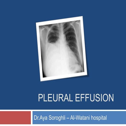 Pleural effusion , deffention diagnosis and treatment | PPT