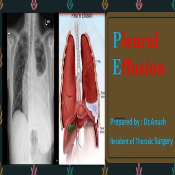 Pleural effusion dr.anush | PDF