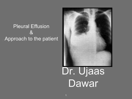 A Study of Role of Medical Thoracoscopy in Undiagnosed Pleural Effusion ...