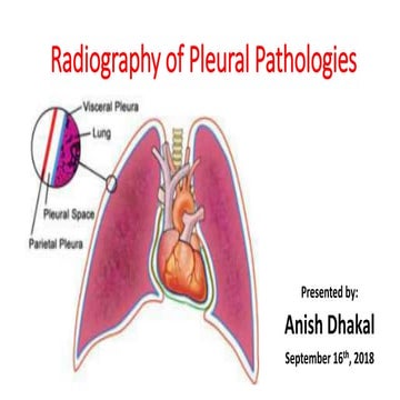 Pleural Effusion & Pneumothorax radiology made simple by Anish Dhakal ...