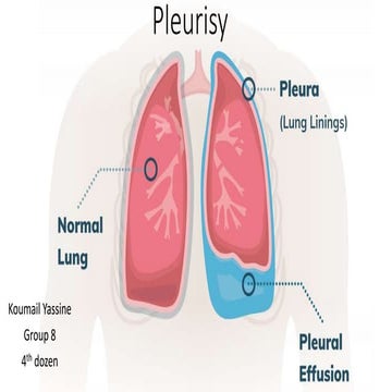 Pleurisy | PPTX