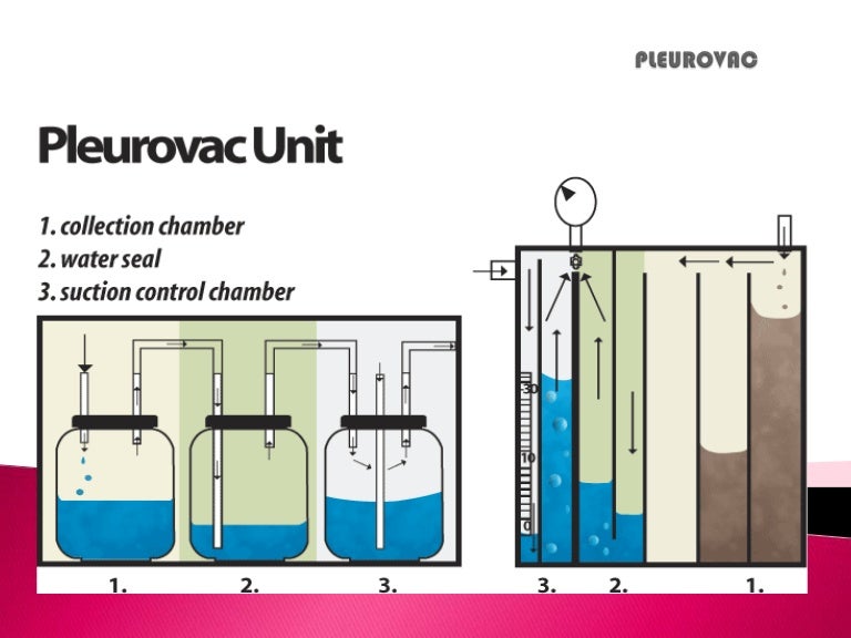 Chest tube삽입 환자 간호 : 네이버 블로그