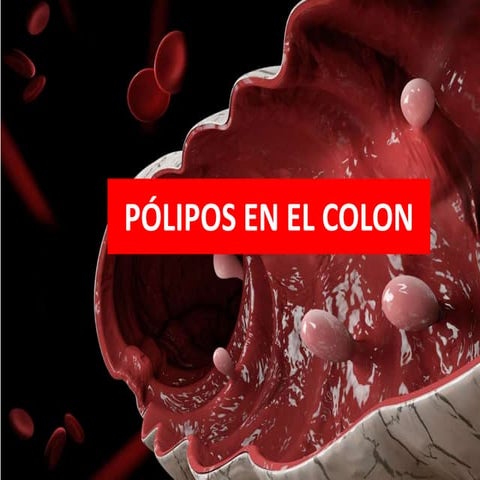 PÓLIPOS EN EL CÓLON.pptx