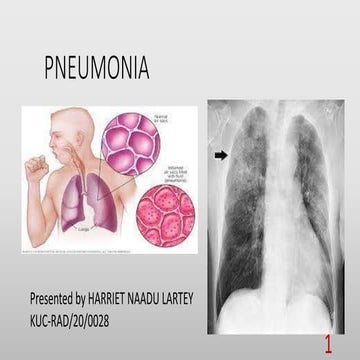 PNEUMONIA.pptx