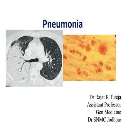 CASE PRESENTATION ON PNEUMONIA | PPTX