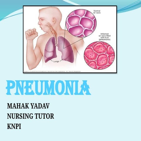 Pneumonia | PPSX