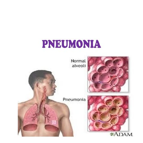 PNEUMONIA PPT.power point presentation ppt | PPTX