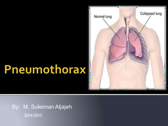 pneumothorax 1.pptx definition, types, clinical features, diagnosis ...