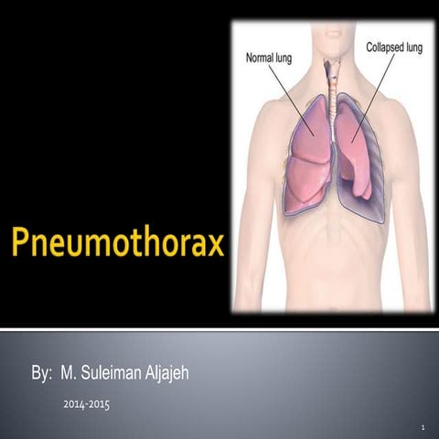 Pneumothorax PPT | PPTX