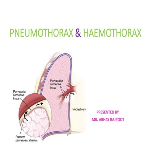 Hemothorax | PPTX