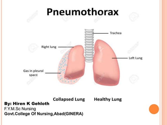Pneumothorax ppt 368 final.... | PPT