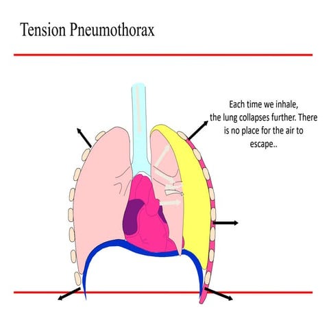 pneumothorax for Emergency and critical care nursing students | PPTX