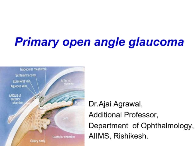 Neovascular Glaucoma ophthalmology medicine | PPTX
