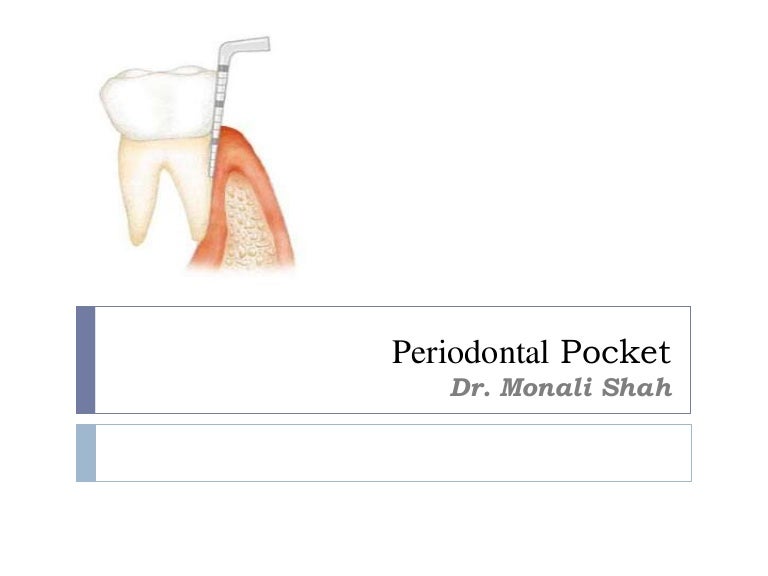 Periodontal Pocket