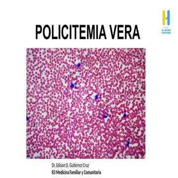 policitemia vera, poliglobulia vera, poliglobulia primaria | PPTX