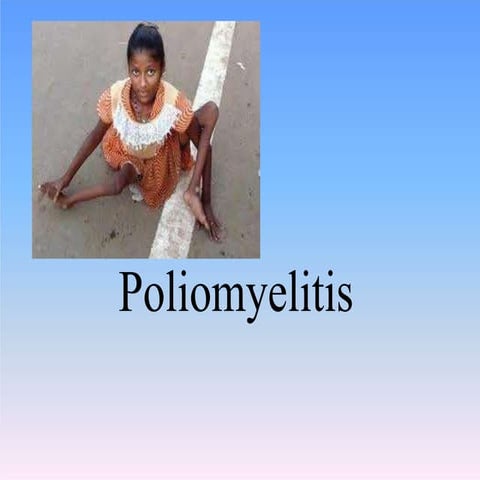 Poliomyelitis | PPTX