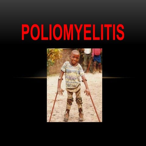 Poliomyelitis | PPTX