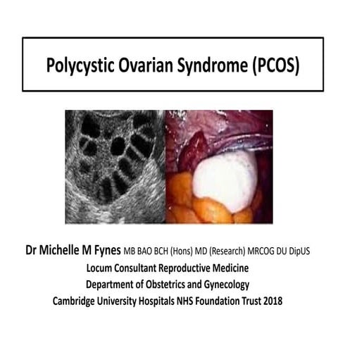 Polycystic Ovary Syndrome (PCOS) | PDF