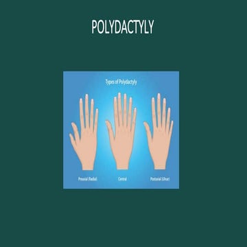Polydactyly | PPTX