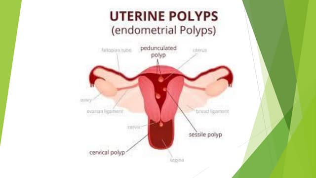 Endometrial polyp | PPTX | Reproductive Health | Diseases and Conditions
