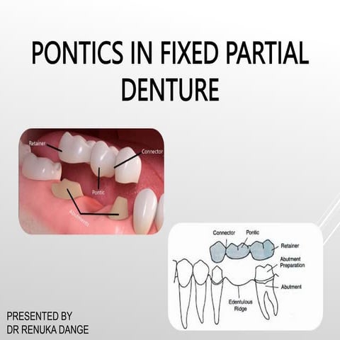 PONTICS IN FIXED PARTIAL DENTURE FOR ORAL | PPT