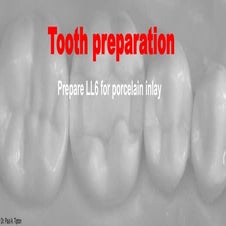 Tooth Preparation - Porcelain Inlays & Onlays | PDF