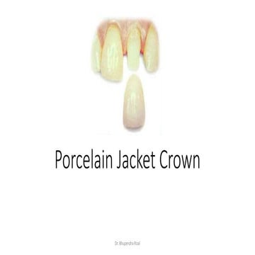 Porcelain jacket crown (PJC) | PPTX