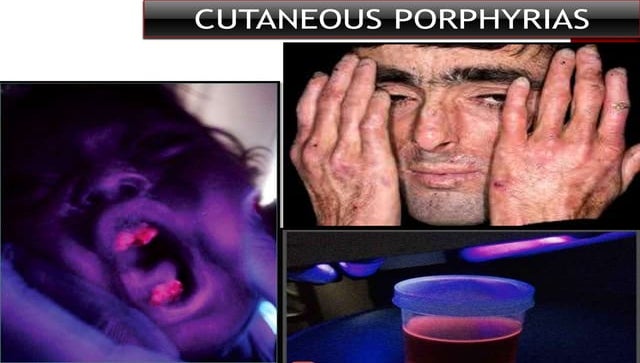 Porphyria Werewolf