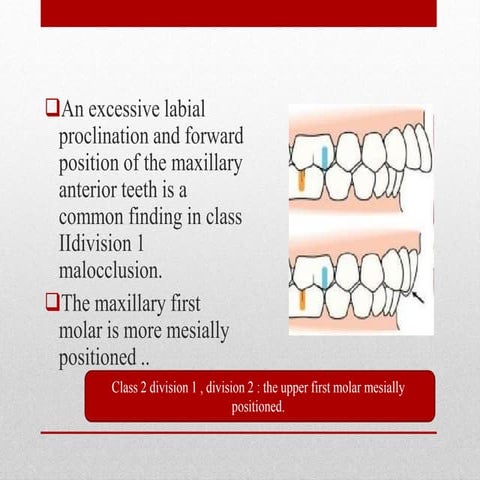 Class II division 2 malocclusion | PPTX