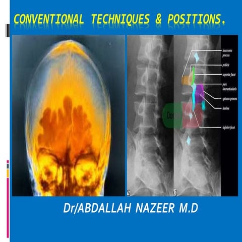 TOWNE VIEW of the skull. X-ray special procedure of skull. | PPTX