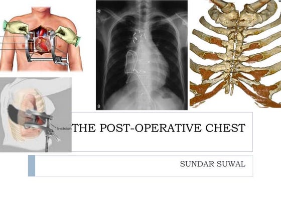 PNEUMOTHORAX IN CHEST XRAY INTERPRETATIONpptx | PPTX
