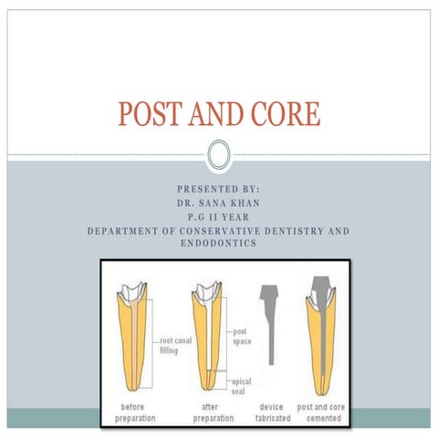 Post and core | PPT