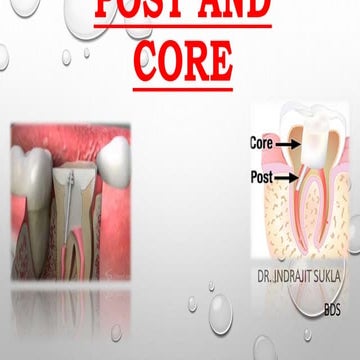 Post and core short by Dr.Soumya Ranjan | PPTX