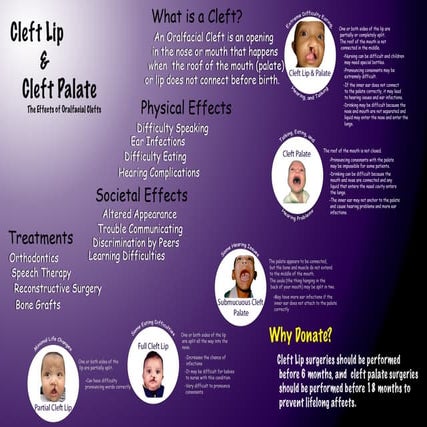 CURE (2012): Cleft Palate Infographic | PDF